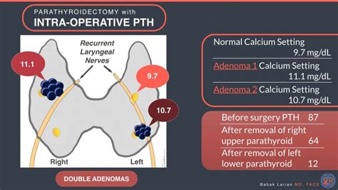 Intraoperative Parathyroid Hormone Pth Testing Dr Babak Larian