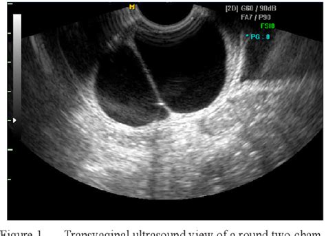 Nabothian Cyst Semantic Scholar