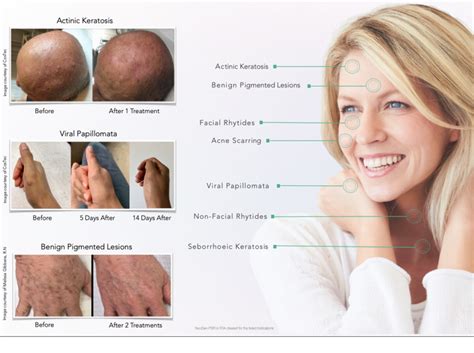 NeoGen Results – Cincinnati NeoGen Plasma Skin Regeneration