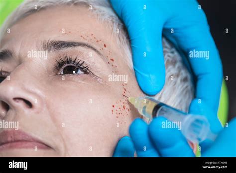 Platelet Rich Plasma Facial Treatment Close Up Of Mature Woman
