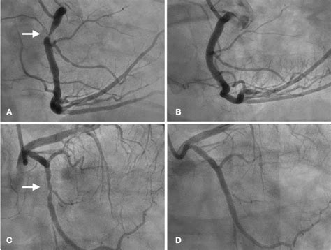 Adriano Caixeta Md Phd On Linkedin A Patient With Multivessel Disease Rca Lcx And Lad Dg
