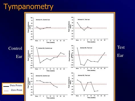 Patulous Eustachian Tube Test Tympanometry At Nicholas Barrallier Blog