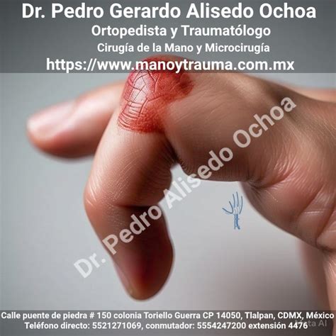 Revisionesbibliográficas Tyoweb Impacto De La Tenólisis Por Tracción