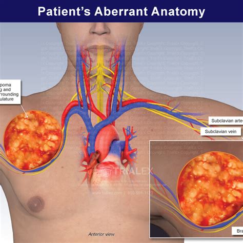 Compression Of The Left Brachial Plexus Trial Exhibits Inc Compression Of The Left Brachial Plexus Trial Exhibits Inc