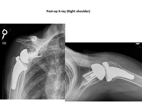 Reverse Total Shoulder Replacement Boston Shoulder Institute