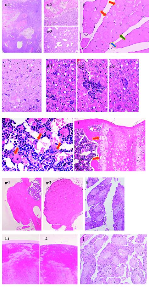 A Sarcoma Nos In The Subcutaneous Tissue A 1 In A Female Download Scientific Diagram