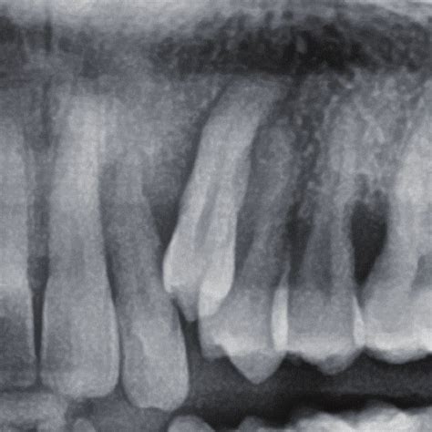 Classification Of Canine Impaction According To Yamamoto Et Al 2003
