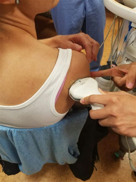 Pocus Shoulder Dislocation — Brown Emergency Medicine