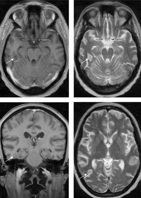 Axial T1 Weighted Postcontrast B Axial T2 Weighted C Coronal