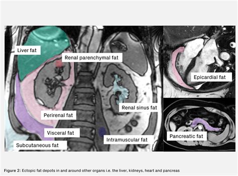 Underneath The Lost Kilos Using Mri Based Body And Muscle Composition