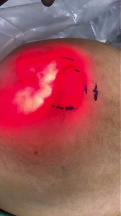 Divarication Of Recti With Umbilical Hernia — Thin Abdomen Youtube