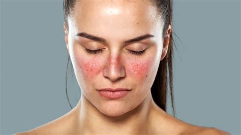 10 Early Signs Of Lupus Page 9 Things Health