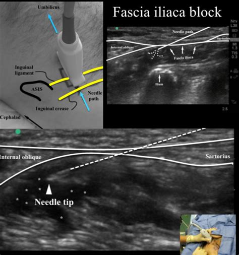 Fascia Iliaca Block — Kwak Talk