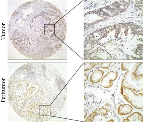 Ebi3 Expression In Gastric Cancer Gc Cell Lines And Gc Tissues A