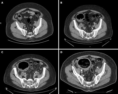 Natural History And Surgical Treatment Of A Giant Colonic Diverticulum