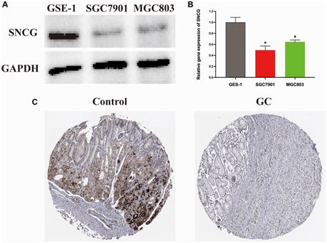 Identification And Validation Of Anoikis Associated Gene Sncg As A