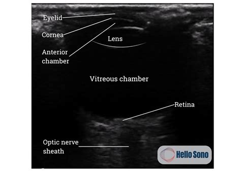 Detecting Increased Intracranial Pressure With Ocular Point Of Care Ultrasound Pocus — Hello