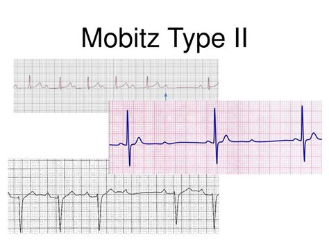 Ppt Atrioventricular Av Heart Block Powerpoint Presentation Free Download Id 613537