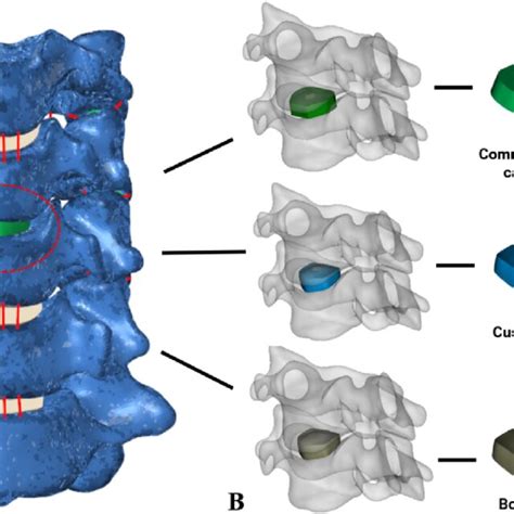 3d View Of Implants Used In Acdf Models A Acdf Model And B Three Download Scientific