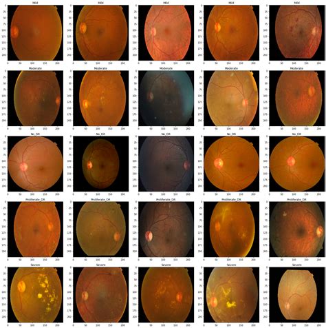 Github Sreemanbharadwaz Blindness Detection Using Deep Learning
