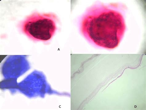 A Cytology Smear Showing Scolex Of Echinococcus Granulosus Hande