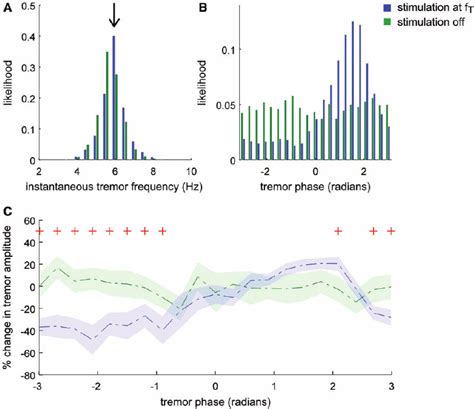 Exemplar Effect Of Dbs On Essential Tremor In Patient 6 Dbs At Near