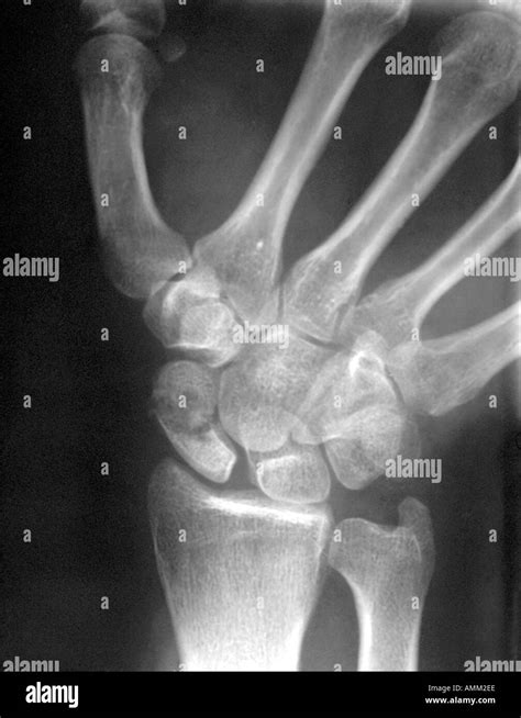 Ulnar Deviation X Ray Scaphoid Tubercle Fracture