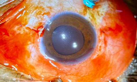 Blog Intraocular Lens Dislocation Prime Retina Eye Care Centre