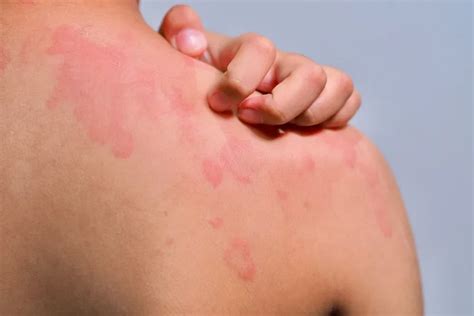 What Is Urticaria Hives Causes Appearance And Types