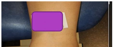 Understanding The Balgrist Score For Charcot Foot
