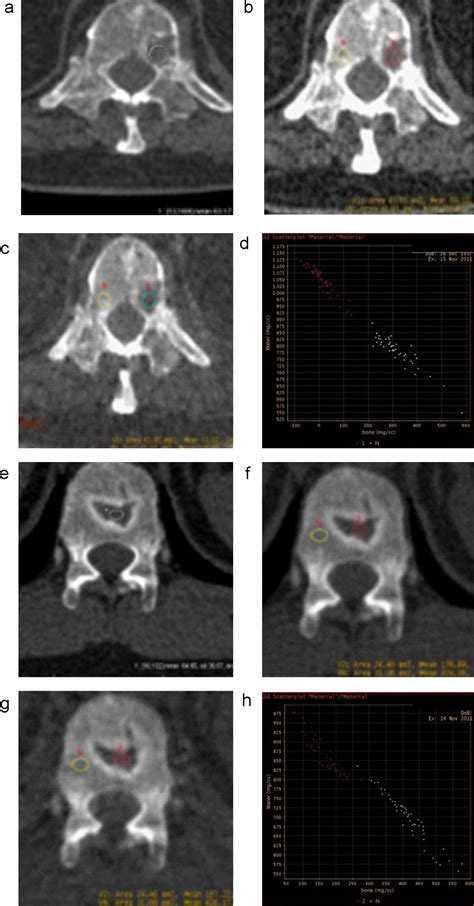 Differentiation Of Osteolytic Metastases And Schmorls Nodes In Cancer