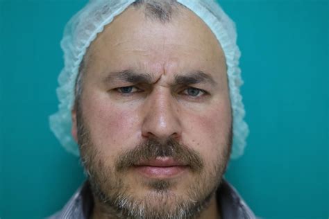 Dermadetection Object Detection Dataset By Dermatologydataset