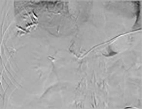 December 2019 Procedure Ir Venogram Procedure Hepatic Arterial Download Scientific Diagram