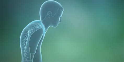 Fizyorama Blog Scheuermann Kifozu Nedir