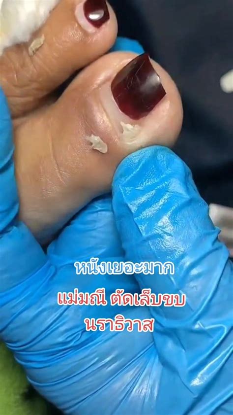 Ingrown Toe Nail Treatment Didnt Look Like Much At First But
