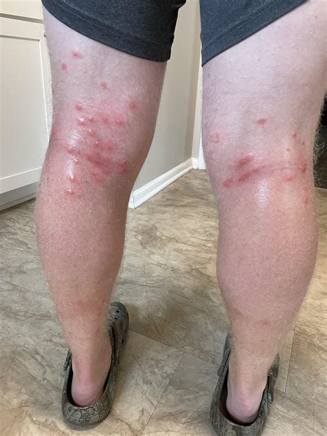What Are These Bug Bites Mosquito Rash Allergic Reaction Poison Ivy Oak R