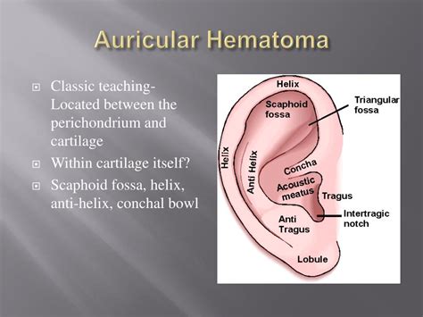 Ppt Management Of Auricular Hematoma Powerpoint Presentation Free