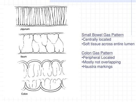 Ppt Ileus Powerpoint Presentation Free Download Id 2917456
