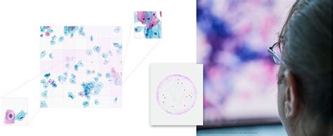 Hologic Ai Powered Cervical Cancer Screening For All Slalom