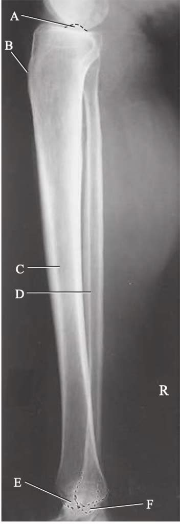 Lateral Tib Fib Diagram Quizlet