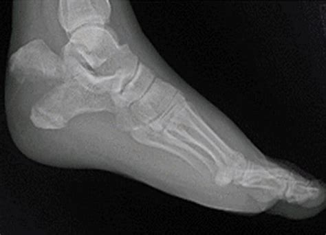 Calcaneus Fractures Trauma Orthobullets