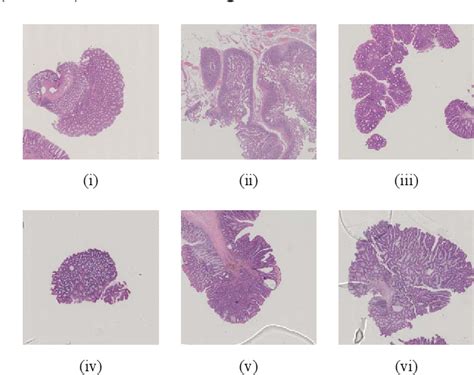 Figure 1 From Histopathological Classification Of Colorectal Polyps Using Deep Learning