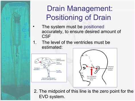External Ventricular Drain Ppt