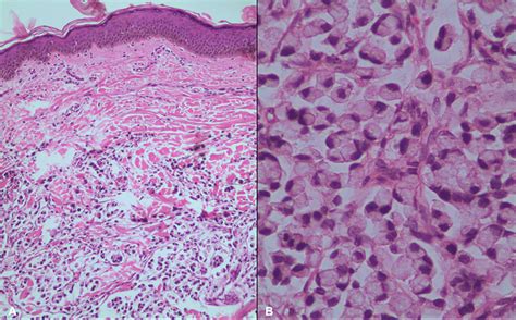 Signet Ring Carcinoma Of Colon Signet Ring Cells In Gastric Carcinomas