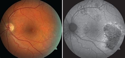 Fluorescent Fundus Photography