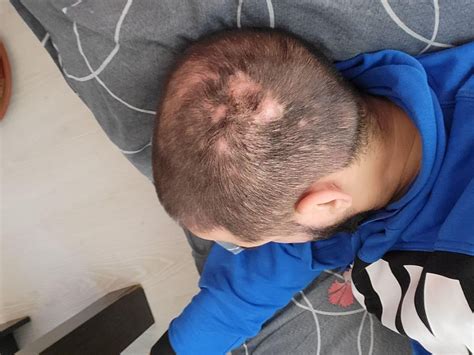 Does Anyone Else Get Scalp Folliculitis Every Time You Get A Haircut