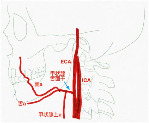 脑血管解剖学习笔记第21期：面动脉起源的变异 脑医汇 神外资讯 神介资讯