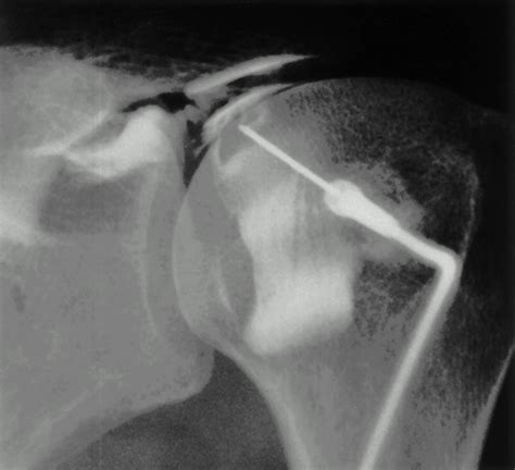 Patients Assessment Of Discomfort During Mr Arthrography Of The