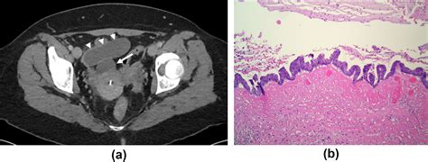 The Appendix “mucocoele” Misnomer Radiological Terminology Of “likely