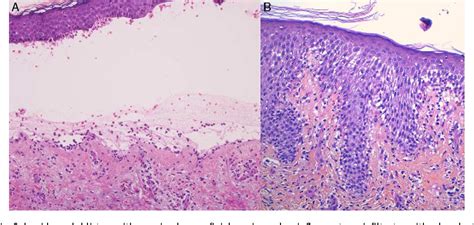 Bullous Pemphigoid Clinical Practice Guidelines Cid Semantic Scholar